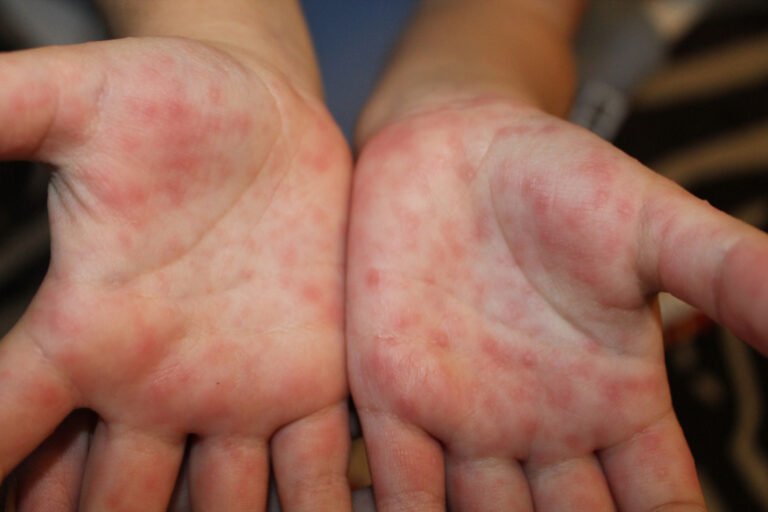 Bostonka czym smarować, by szybko wrócić do zdrowia? - SkyClinic